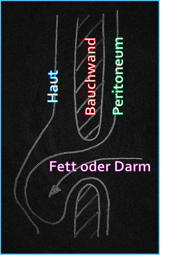 Leistenbruch – Inguinal­­­hernie – Praxis Chirurgie